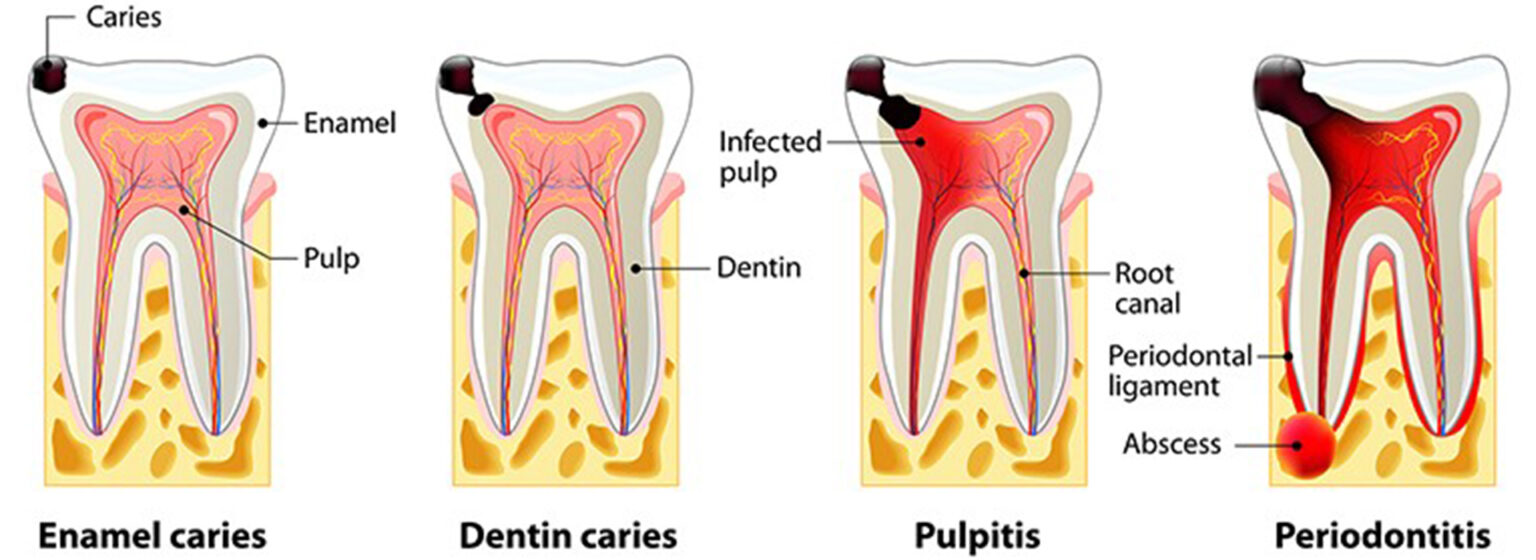 Root Canal Treatment Mount Pleasant Dental Clinic root-canal-treatment-mount-pleasant-dental-clinic